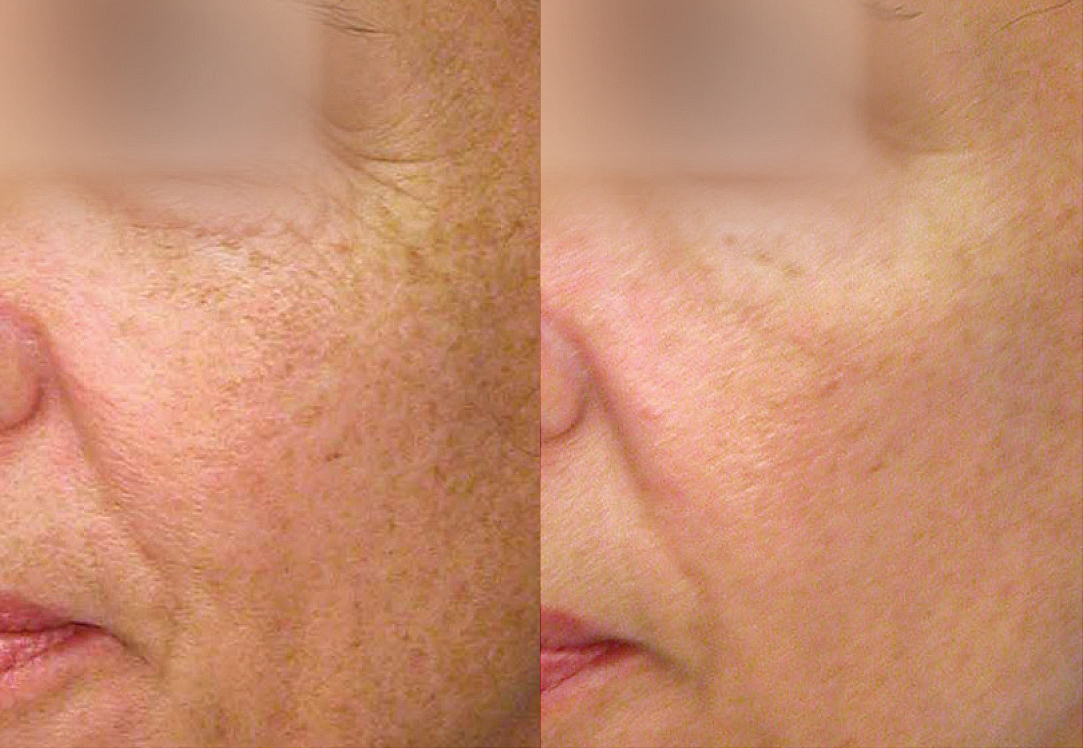 Skin Rejuvenation in Medford, OR | Pure Medspa